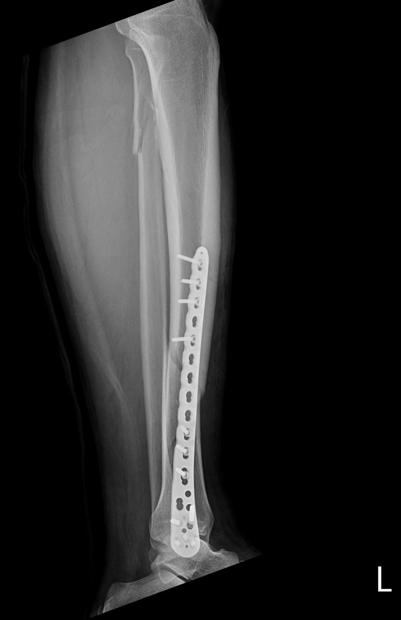 경비골 골절 Tibia & Fibula fracture / 경골 개방정복술 Tibia OR/IF ; Tibia Open ...