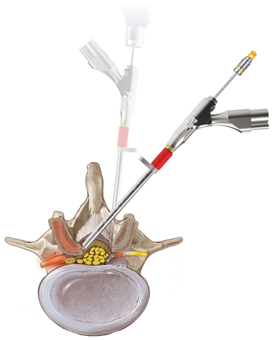 척추내시경; PSLD-허리디스크수술-허리디스크-우리들병원-은상수 : 네이버 블로그