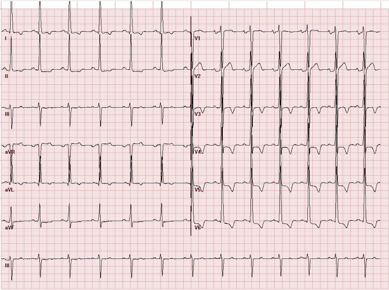 Hypertrophic cardiomyopathy, LVH ECG : 네이버 블로그