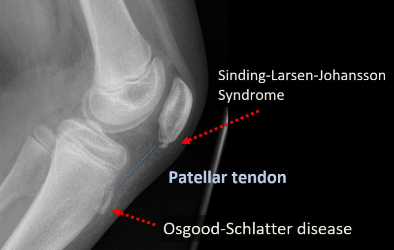 Sinding Larsen Johansson Syndrome