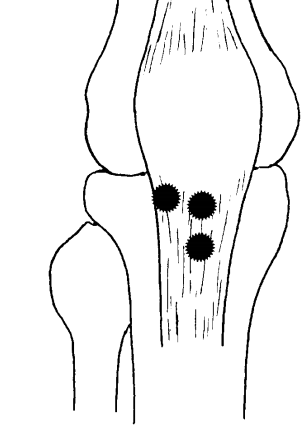 Sinding-Larsen-Johansson Syndrome 의 Rehab (SLJ syndrome) - 청소년기 전방무릎통증 ...