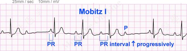 EKG (2) bradycardia : 네이버 블로그