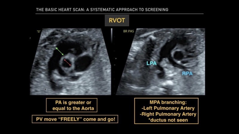 AIUM 12개의 CME 합격증과 강의 정리 ,Basic Heart Scan,systematic approach [AIUM 태아 ...