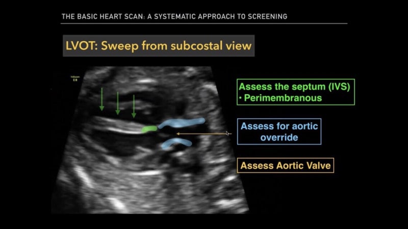 AIUM 12개의 CME 합격증과 강의 정리 ,Basic Heart Scan,systematic approach [AIUM 태아 ...
