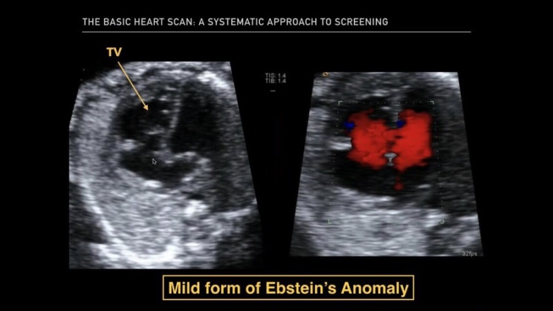 AIUM 12개의 CME 합격증과 강의 정리 ,Basic Heart Scan,systematic approach [AIUM 태아 ...