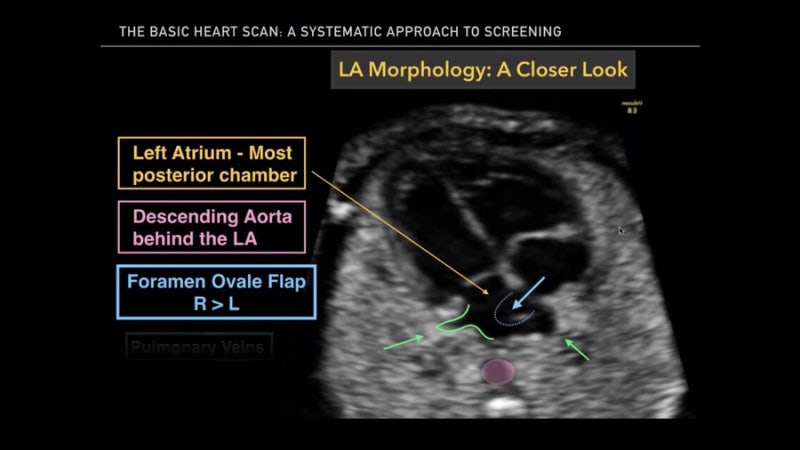 AIUM 12개의 CME 합격증과 강의 정리 ,Basic Heart Scan,systematic approach [AIUM 태아 ...