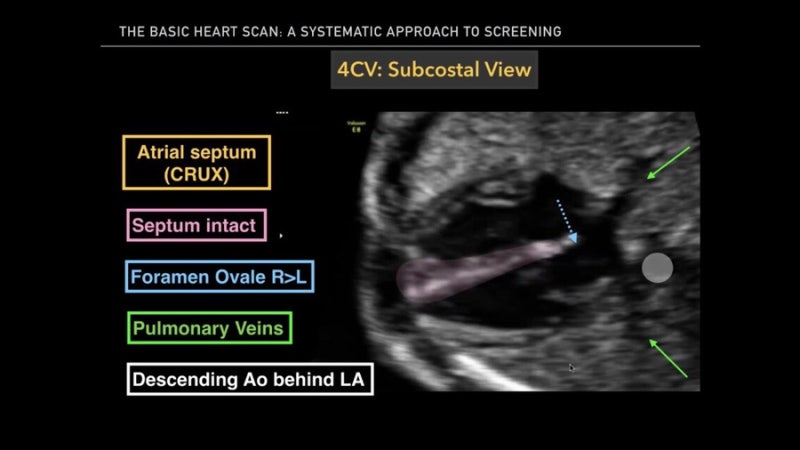 AIUM 12개의 CME 합격증과 강의 정리 ,Basic Heart Scan,systematic approach [AIUM 태아 ...
