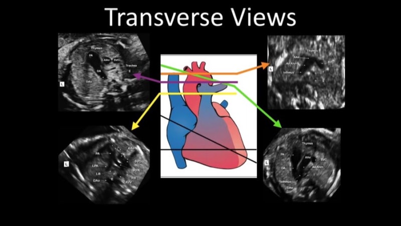 요약]Advanced evaluation of the fetal heart, Dr.Abuhamad, AIUM 강의 정리( 비정상 ...