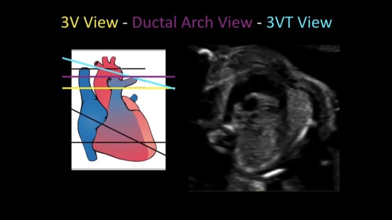 요약]Advanced evaluation of the fetal heart, Dr.Abuhamad, AIUM 강의 정리( 비정상 ...
