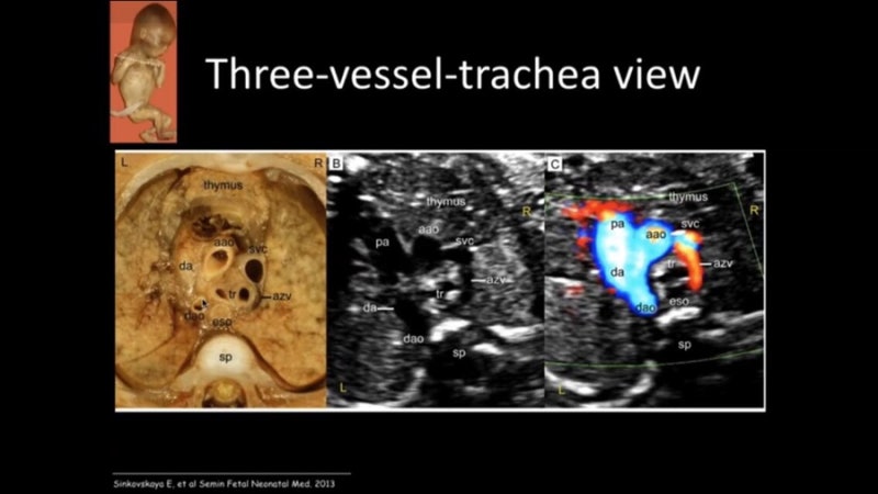 요약]Advanced evaluation of the fetal heart, Dr.Abuhamad, AIUM 강의 정리( 비정상 ...