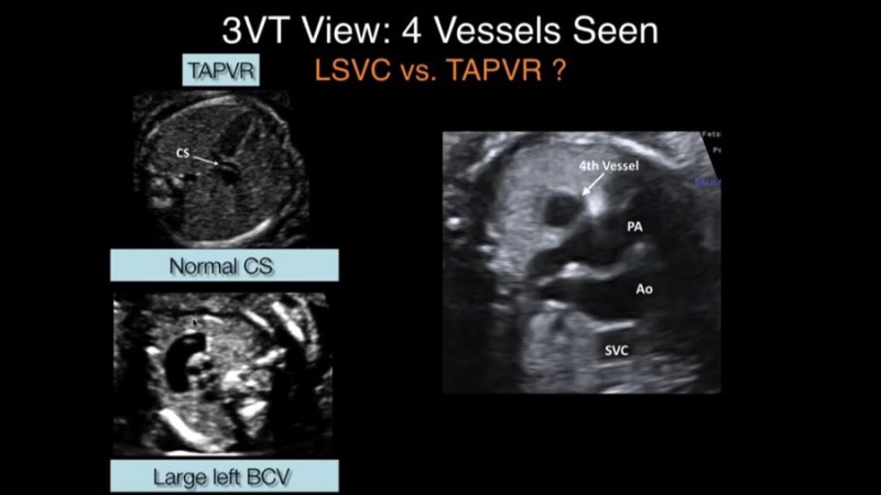 요약]Advanced evaluation of the fetal heart, Dr.Abuhamad, AIUM 강의 정리( 비정상 ...
