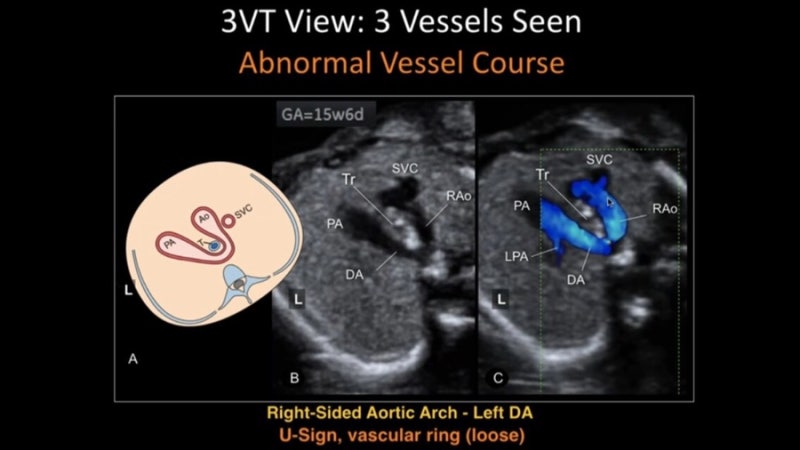 요약]Advanced evaluation of the fetal heart, Dr.Abuhamad, AIUM 강의 정리( 비정상 ...
