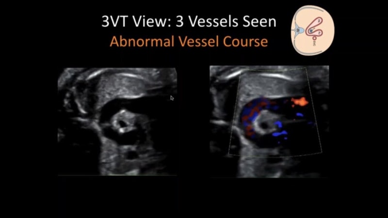 요약]Advanced evaluation of the fetal heart, Dr.Abuhamad, AIUM 강의 정리( 비정상 ...