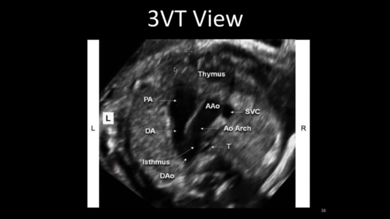 요약]Advanced evaluation of the fetal heart, Dr.Abuhamad, AIUM 강의 정리( 비정상 ...