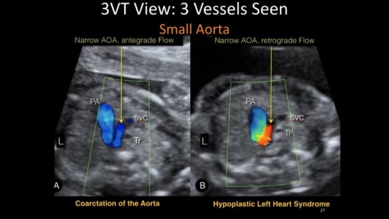요약]Advanced evaluation of the fetal heart, Dr.Abuhamad, AIUM 강의 정리( 비정상 ...