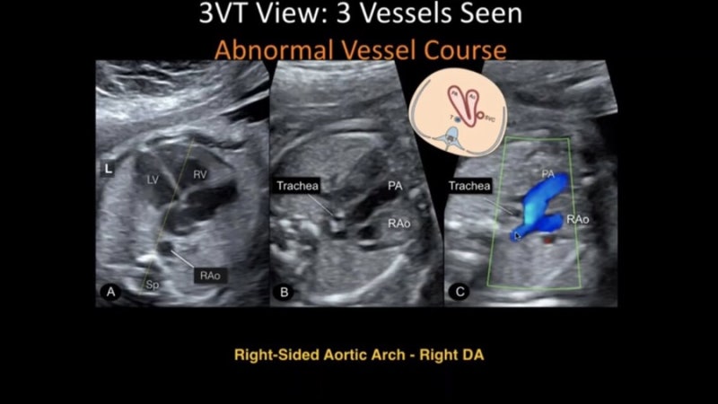 요약]Advanced evaluation of the fetal heart, Dr.Abuhamad, AIUM 강의 정리( 비정상 ...