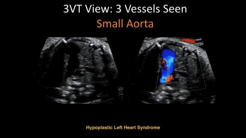 요약]Advanced evaluation of the fetal heart, Dr.Abuhamad, AIUM 강의 정리( 비정상 ...