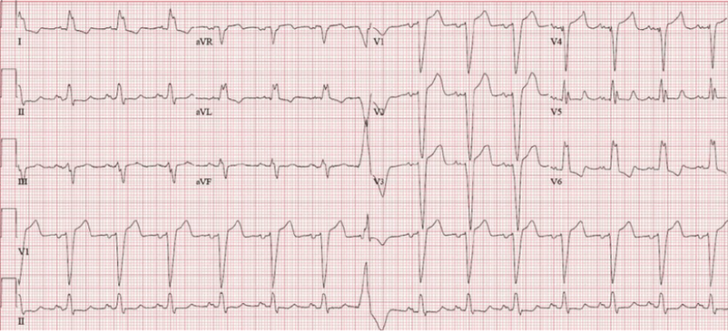 좌심방(왼심방, Left atrium enlargement) 확장/비대 심전도(ECG) 소견: P terminal force ...