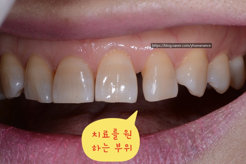 벌어진 앞니 레진 치료1 분당 정자동 정자역 연희세브란스치과 네이버 블로그