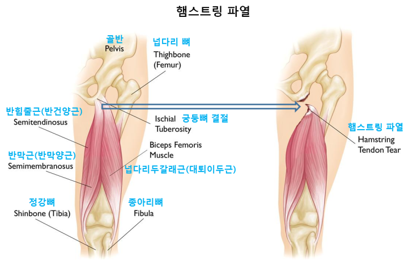햄스트링오금hamstring부상 원인과 증상•질병의 예방은 조금 더 아는 지식입니다 네이버 블로그