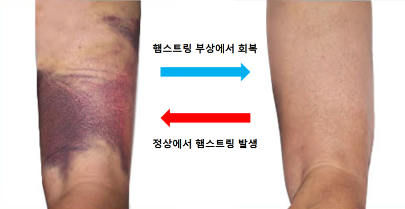햄스트링오금hamstring부상 원인과 증상•질병의 예방은 조금 더 아는 지식입니다 네이버 블로그