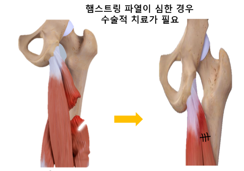 햄스트링오금hamstring부상의 진단과 치료•질병의 예방은 조금 더 아는 지식입니다 네이버 블로그