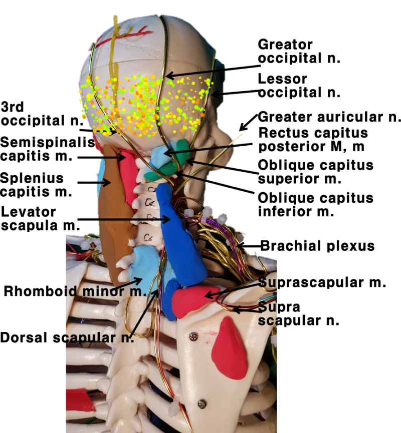Suboccipital Muscles Trigger Points