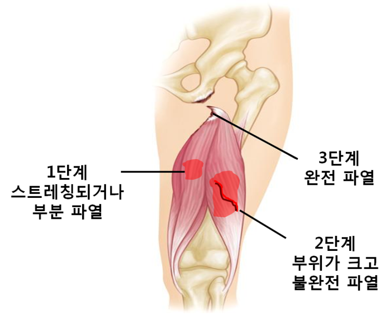햄스트링오금hamstring부상의 진단과 치료•질병의 예방은 조금 더 아는 지식입니다 네이버 블로그