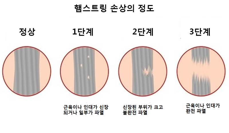 햄스트링오금hamstring부상의 진단과 치료•질병의 예방은 조금 더 아는 지식입니다 네이버 블로그