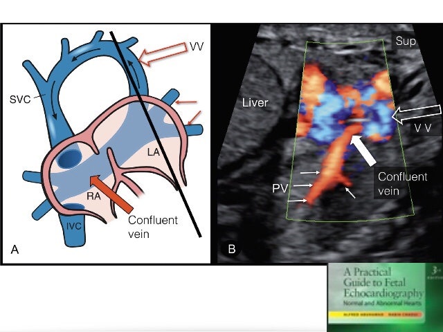 chap 31정리]Anomalies of Systemic and Pulmonary Venous Connection(LSVC ...