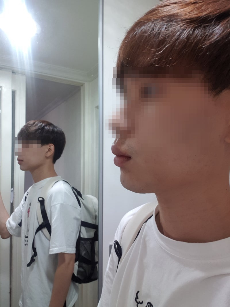 남자 양악수술 후기 23일차 네이버 블로그