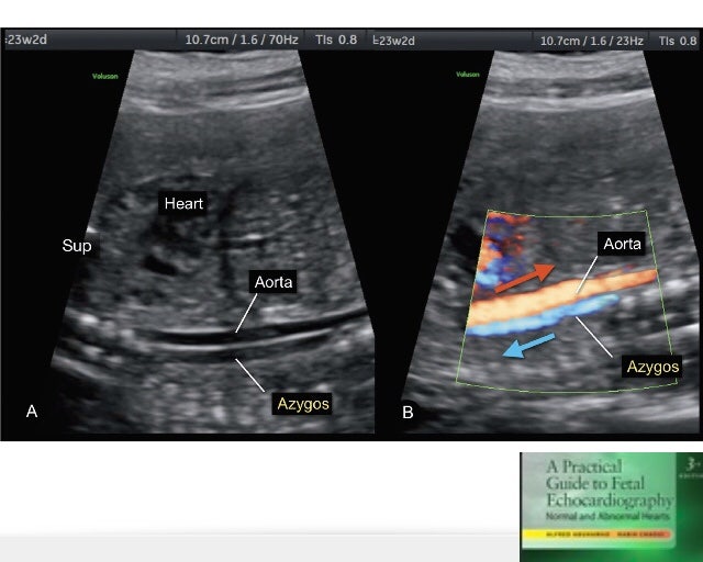 chap 31정리]Anomalies of Systemic and Pulmonary Venous Connection(LSVC ...