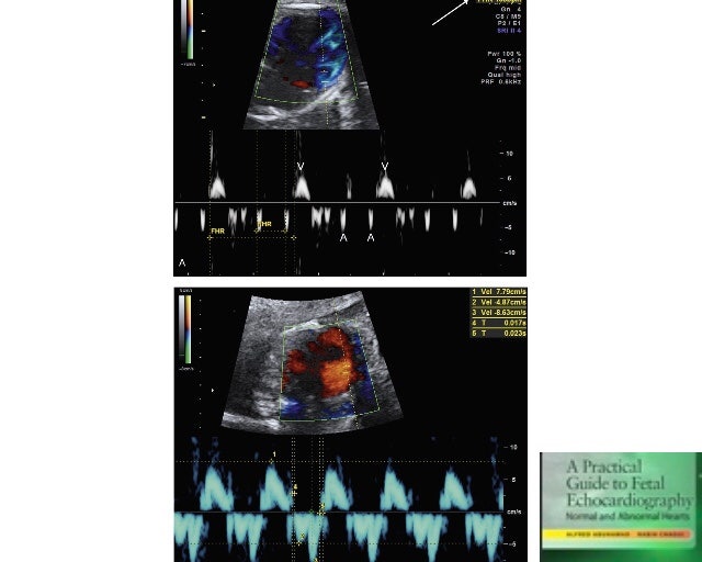 chap 33 정리] Fetal arrhythmias : 네이버 블로그