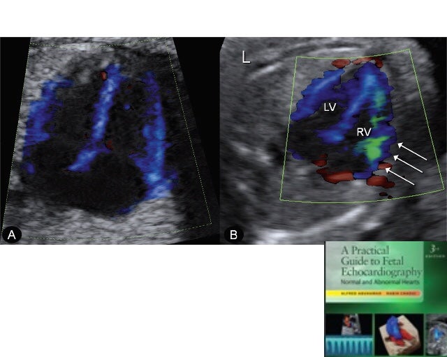 chap 33 정리] Fetal arrhythmias : 네이버 블로그