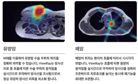 ViewRay MRIdian Linac (뷰레이)이란? : 네이버 블로그