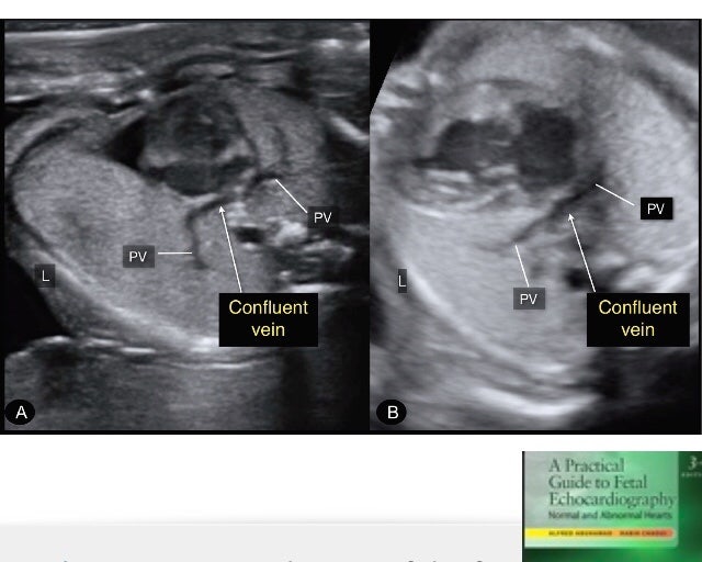 chap 31정리]Anomalies of Systemic and Pulmonary Venous Connection(LSVC ...