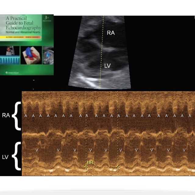 chap 33 정리] Fetal arrhythmias : 네이버 블로그