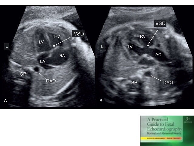 Chap 25. TOF ,PA with VSD, Absent PV SD 요약 정리 : 네이버 블로그