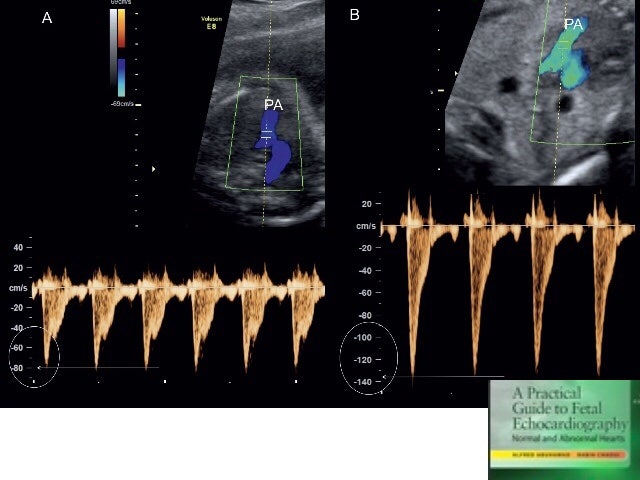 Chap 25. TOF ,PA with VSD, Absent PV SD 요약 정리 : 네이버 블로그