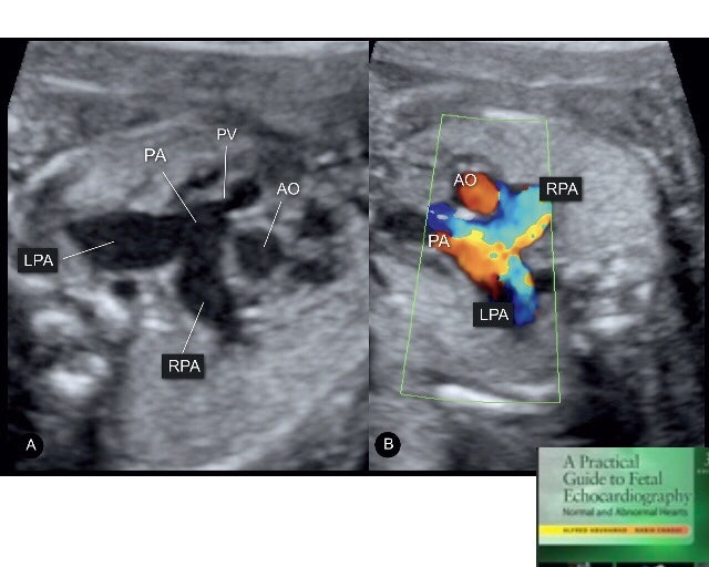 Chap 25. TOF ,PA with VSD, Absent PV SD 요약 정리 : 네이버 블로그