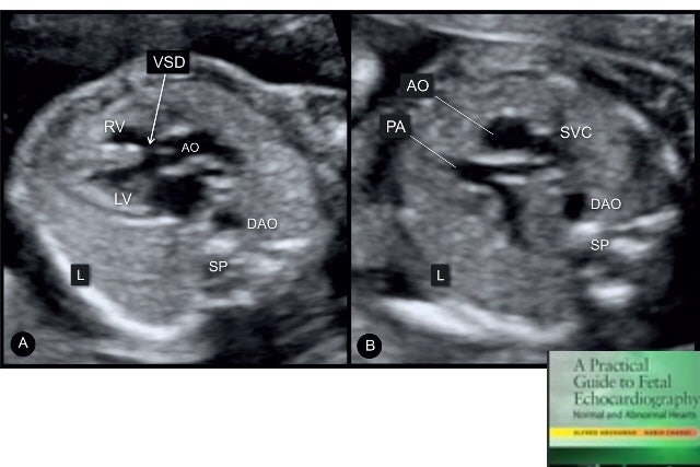 Chap 25. TOF ,PA with VSD, Absent PV SD 요약 정리 : 네이버 블로그