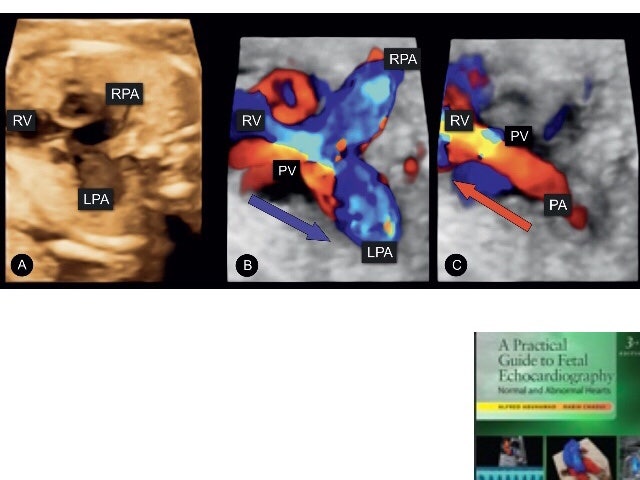 Chap 25. TOF ,PA with VSD, Absent PV SD 요약 정리 : 네이버 블로그
