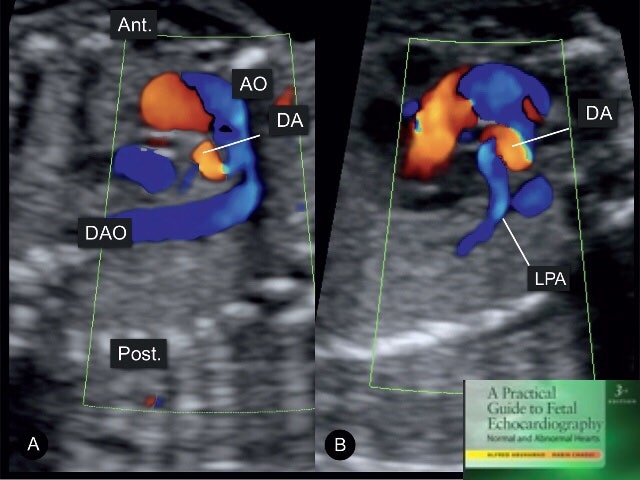 Chap 25. TOF ,PA with VSD, Absent PV SD 요약 정리 : 네이버 블로그