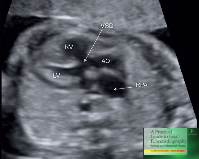 Chap 25. TOF ,PA with VSD, Absent PV SD 요약 정리 : 네이버 블로그