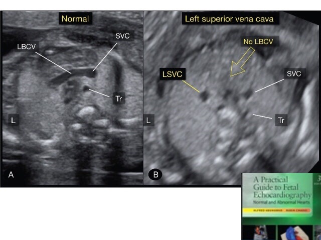 chap 31정리]Anomalies of Systemic and Pulmonary Venous Connection(LSVC ...