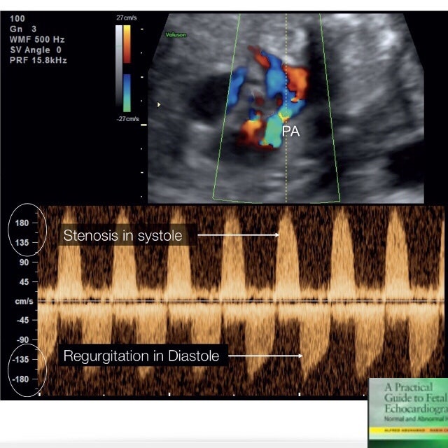 Chap 25. TOF ,PA with VSD, Absent PV SD 요약 정리 : 네이버 블로그