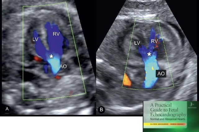 Chap 25. TOF ,PA with VSD, Absent PV SD 요약 정리 : 네이버 블로그