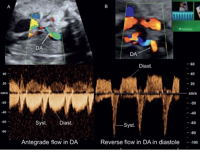 Chap 25. TOF ,PA with VSD, Absent PV SD 요약 정리 : 네이버 블로그