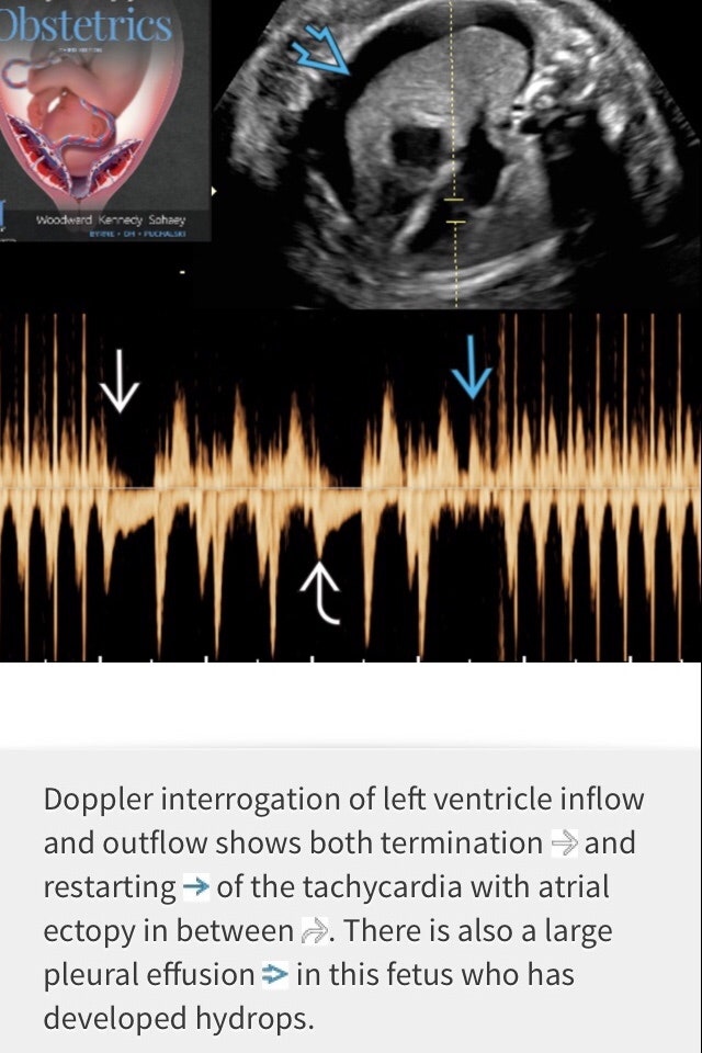 chap 33 정리] Fetal arrhythmias : 네이버 블로그