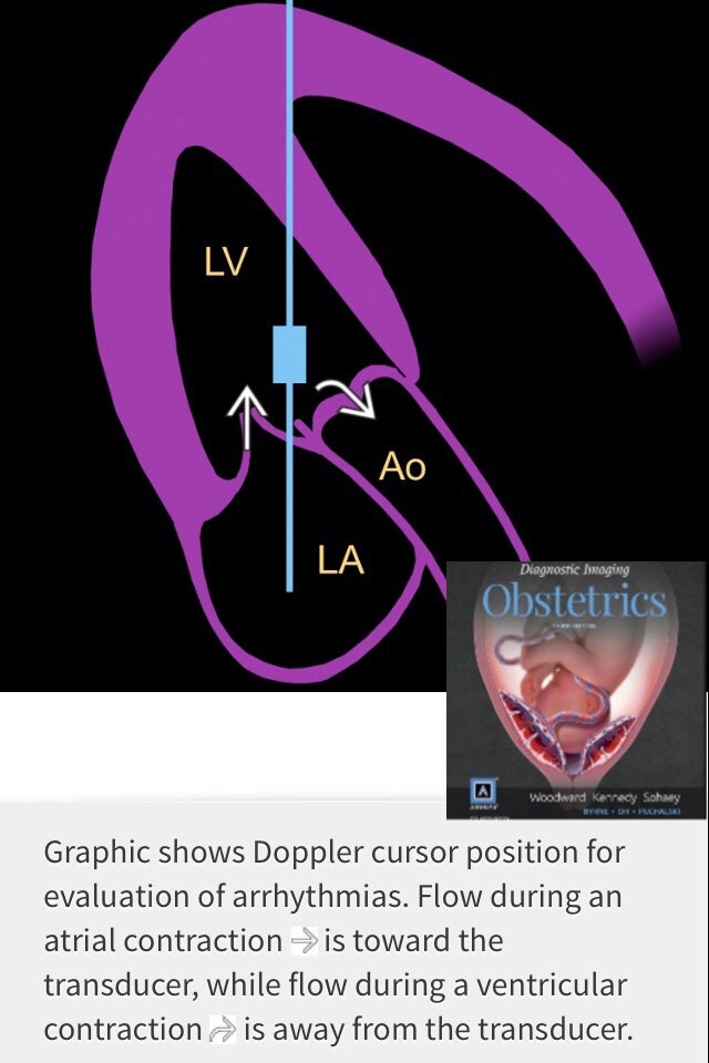 chap 33 정리] Fetal arrhythmias : 네이버 블로그